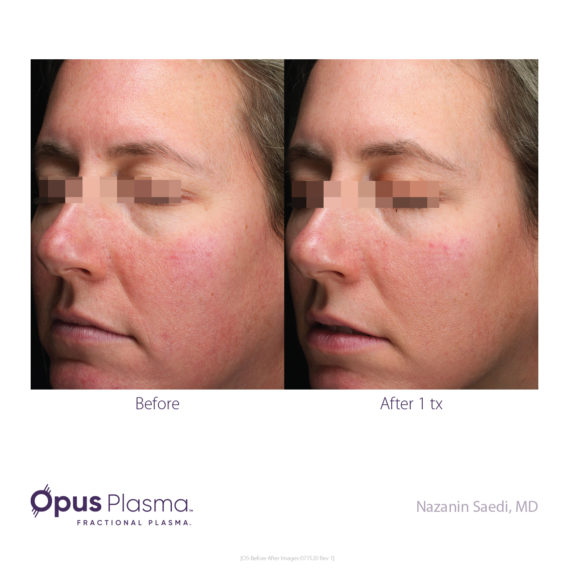 Opus Plasma Skin Resurfacing - Clark Family Dentistry